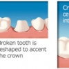 Dental Crowns & Bridges | Grand Junction, CO | Dental Associates of ...
